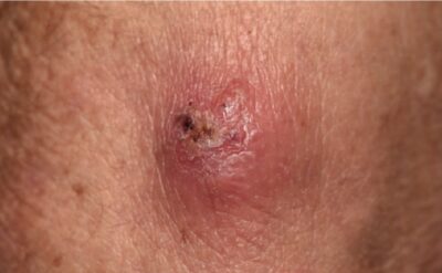 Nocardia/Nocardiosis | Concise Medical Knowledge