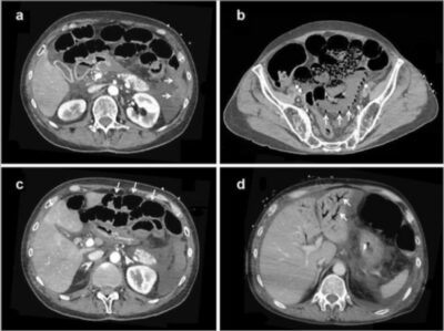 Mesenteric Ischemia | Concise Medical Knowledge
