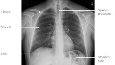 Imaging of the Lungs and Pleura | Concise Medical Knowledge
