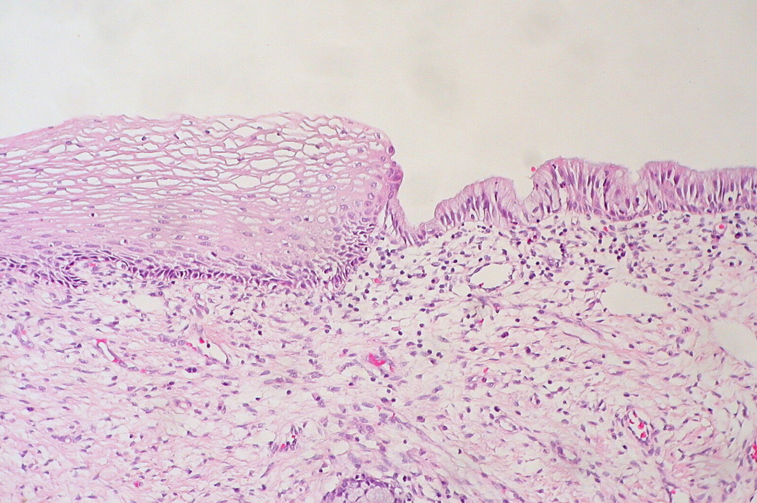 Cáncer Cervical | Concise Medical Knowledge