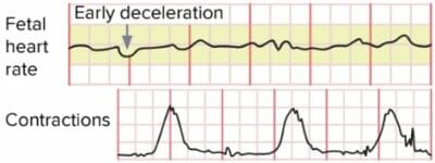 Electronic Fetal Monitoring [+ Free Cheat Sheet] | Lecturio
