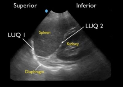 Focused Assessment with Sonography for Trauma (FAST) | Concise Medical ...