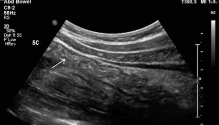 Imaging of the Intestines | Concise Medical Knowledge