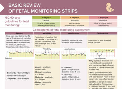 Electronic Fetal Monitoring [+ Free Cheat Sheet] | Lecturio