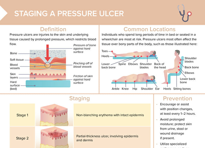 Pressure Sores And Bed Sores Epomedicine 56 OFF