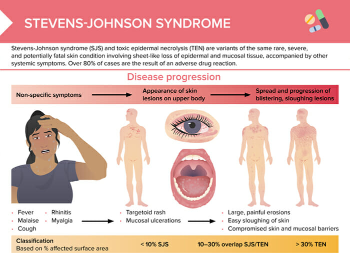 What Is Stevens Johnson Syndrome 54 OFF