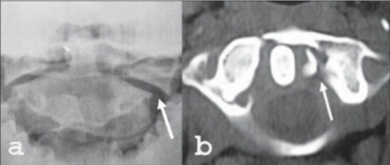 Imagenología de la Columna Vertebral y la Médula Espinal | Concise ...