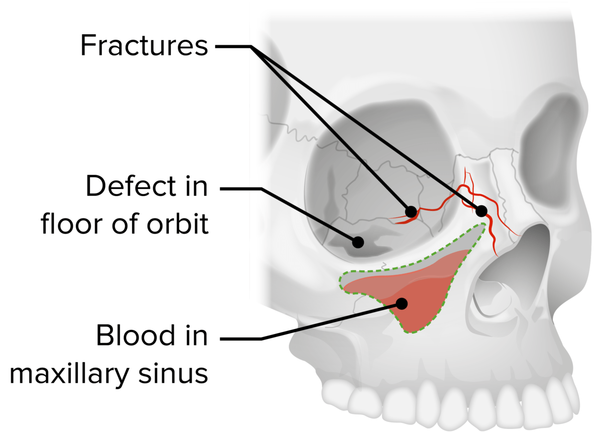 Orbital Fractures | Concise Medical Knowledge