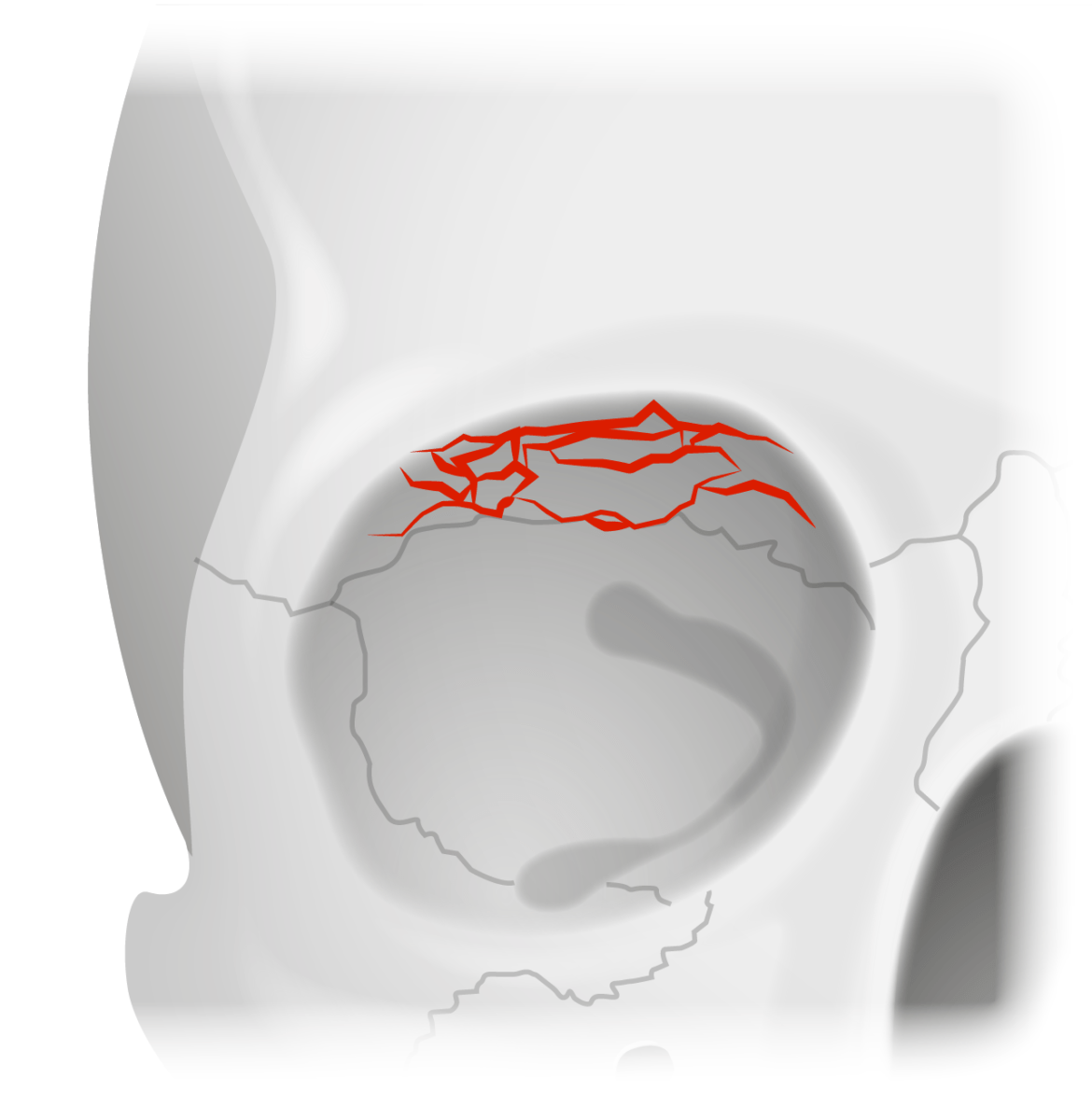 Orbital Fractures | Concise Medical Knowledge