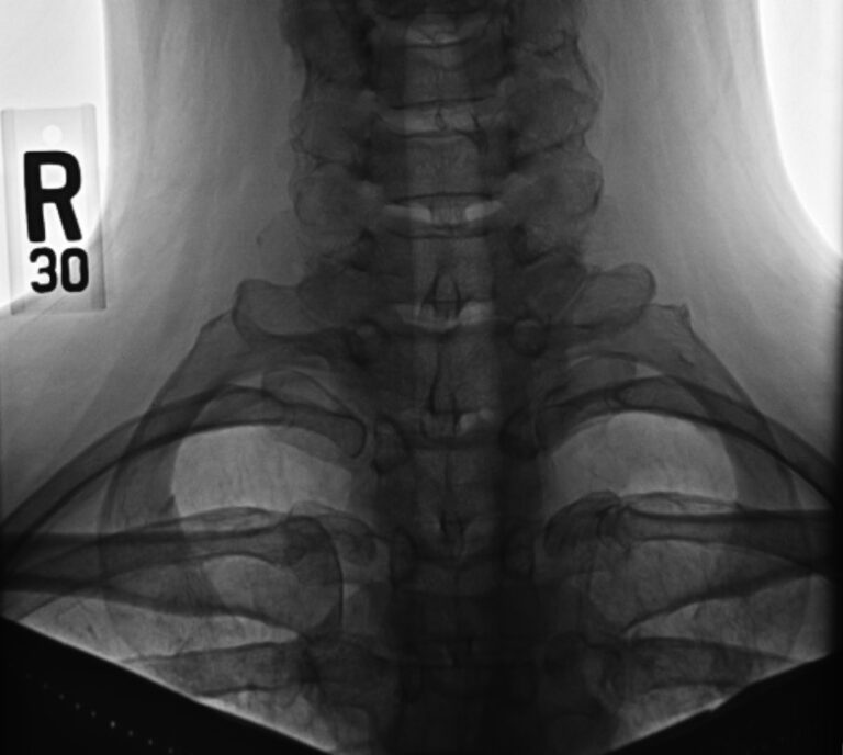 Síndrome de Salida Torácica | Concise Medical Knowledge