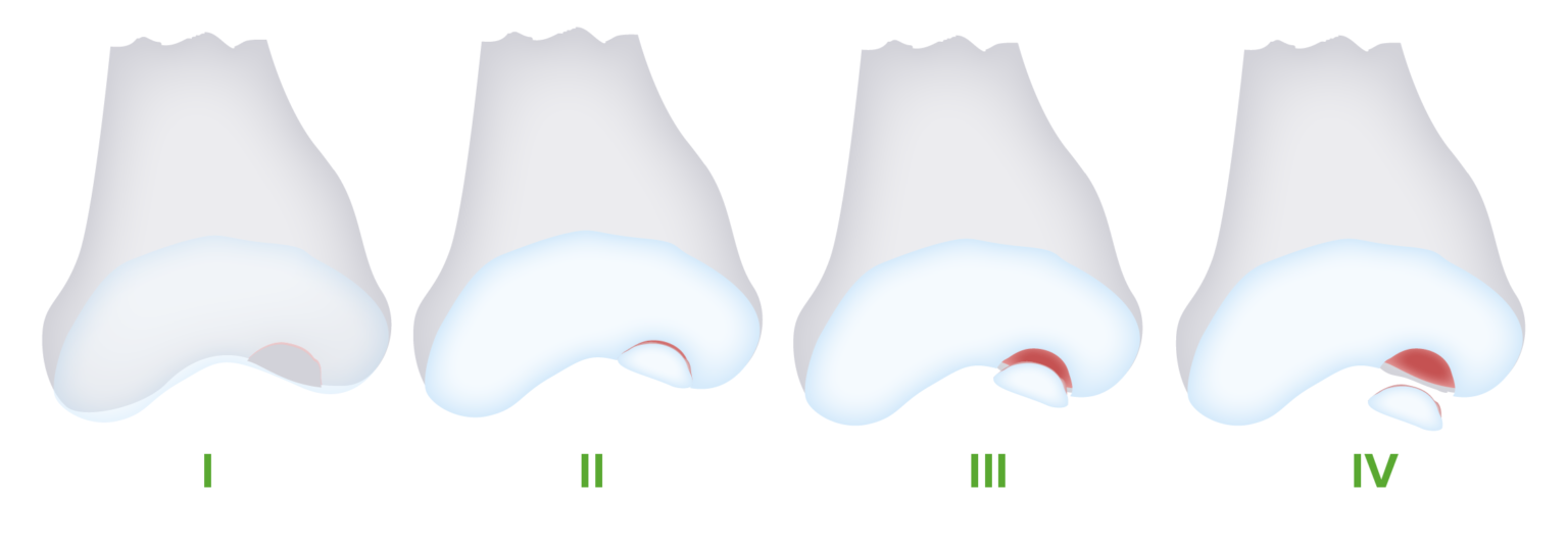 Osteochondritis Dissecans | Concise Medical Knowledge