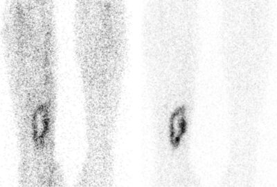 Osteomyelitis | Concise Medical Knowledge