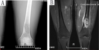 Osteosarcoma | Concise Medical Knowledge