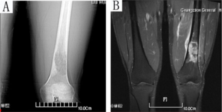 Osteosarcoma | Concise Medical Knowledge