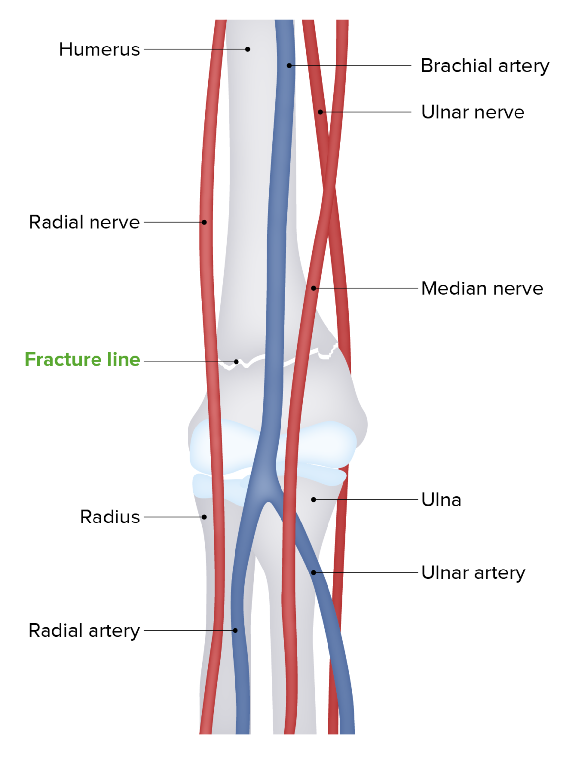 Supracondylar Fracture | Concise Medical Knowledge