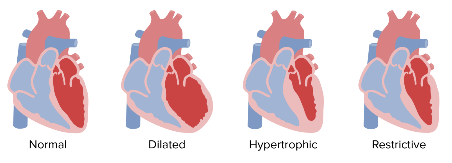 Cardiomyopathy: Overview and Types | Concise Medical Knowledge
