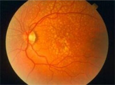 Chorioretinitis | Concise Medical Knowledge