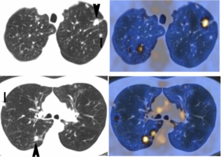 Histiocitosis de Células de Langerhans | Concise Medical Knowledge