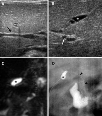 Cholestasis in Neonates and Young Infants | Concise Medical Knowledge