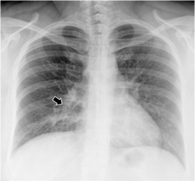 Legionella/Legionellosis | Concise Medical Knowledge