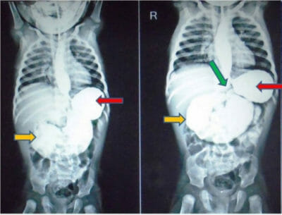 Pediatric Gastrointestinal Abnormalities | Concise Medical Knowledge