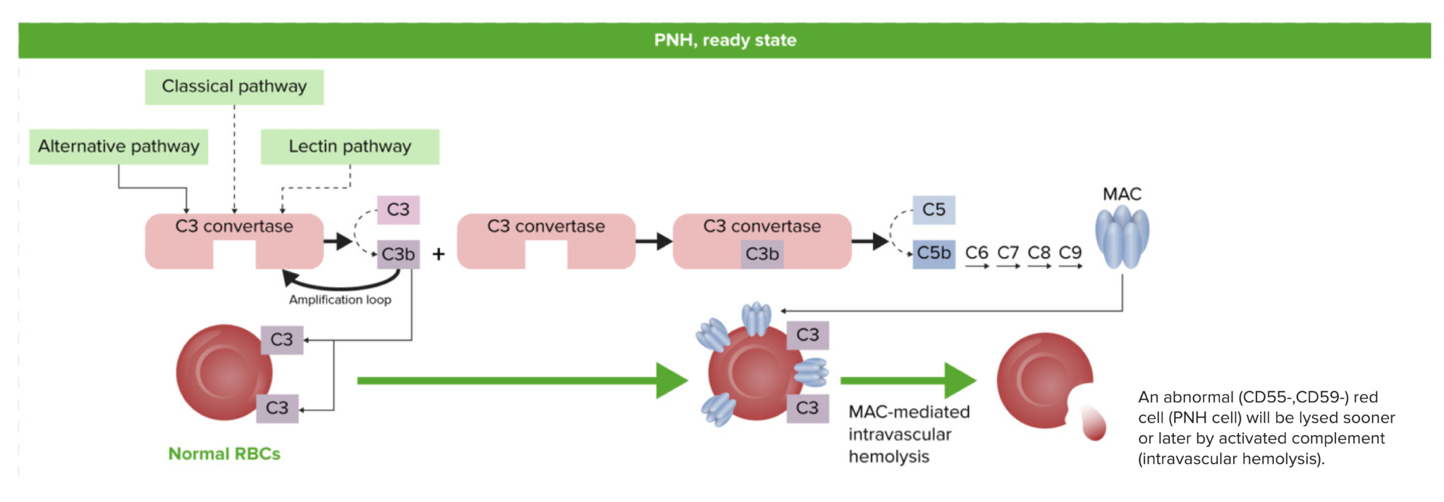 Paroxysmal Nocturnal Hemoglobinuria | Concise Medical Knowledge