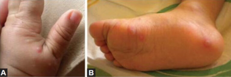 Generalized and Localized Rashes | Concise Medical Knowledge