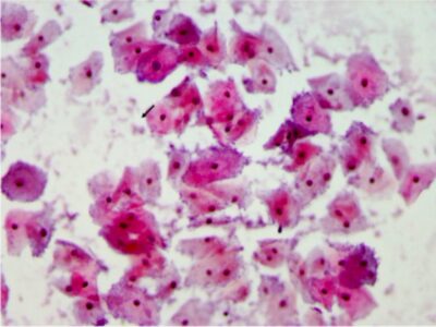 Vulvovaginites | Concise Medical Knowledge