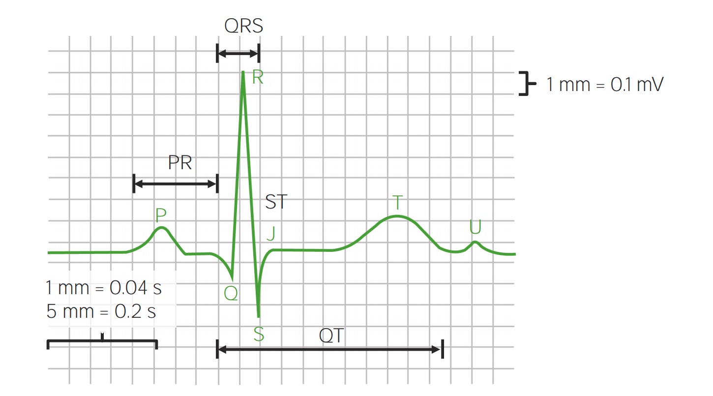 On Ecg Graph Paper An Upward Deflection Represents Electrocardiogram On Ecg Graph Paper An Upward Deflection Represents Electrocardiogram
