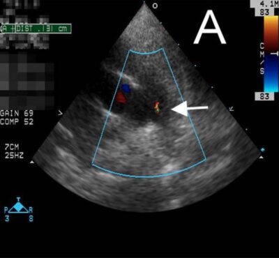 Patent Ductus Arteriosus (PDA) | Concise Medical Knowledge