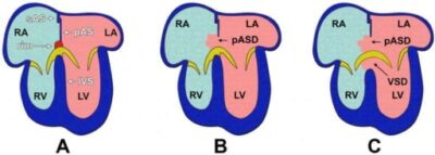 Atrioventricular Septal Defect (AVSD) | Concise Medical Knowledge