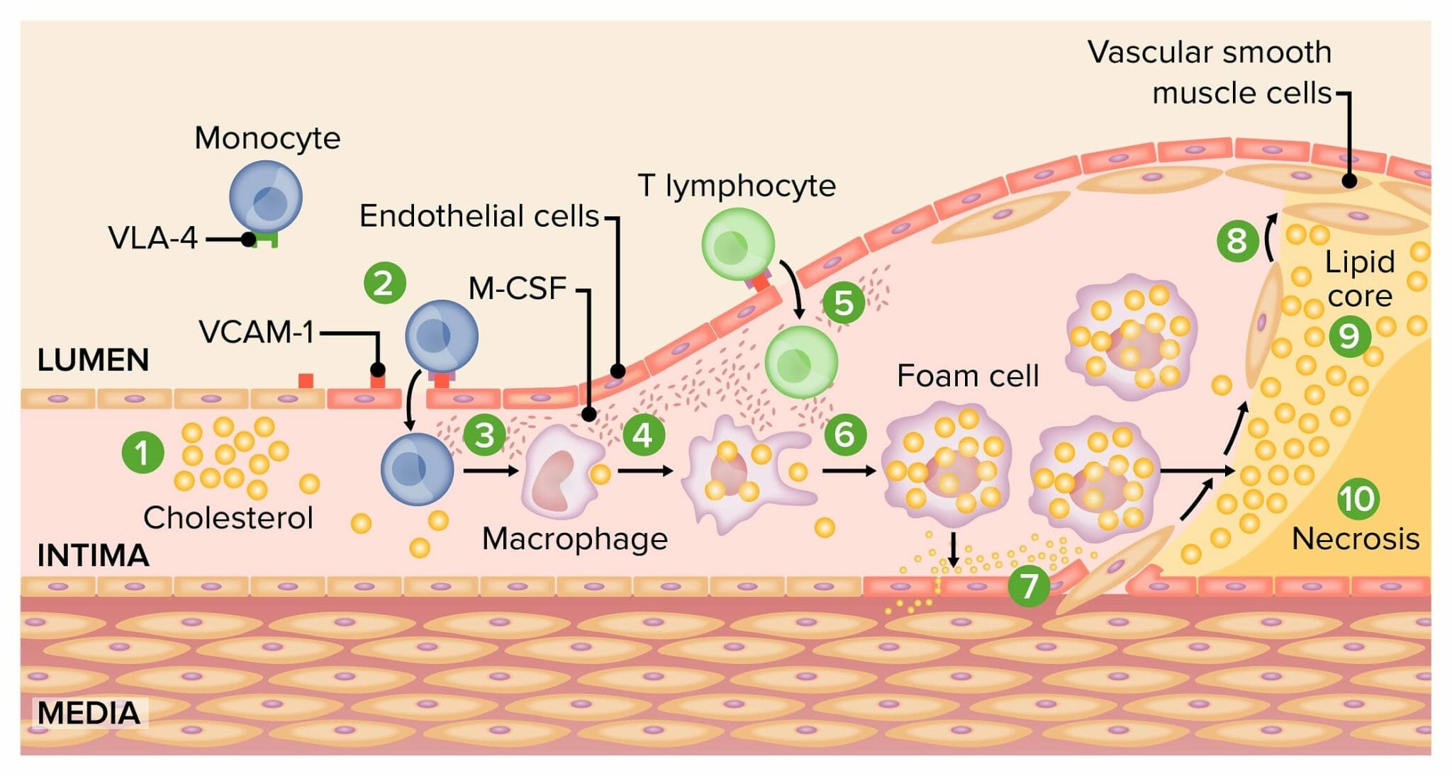 Atherosclerosis | Concise Medical Knowledge