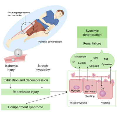 Síndrome de Esmagamento | Concise Medical Knowledge