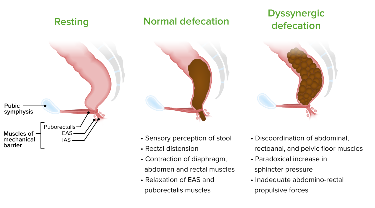 Constipation | Concise Medical Knowledge