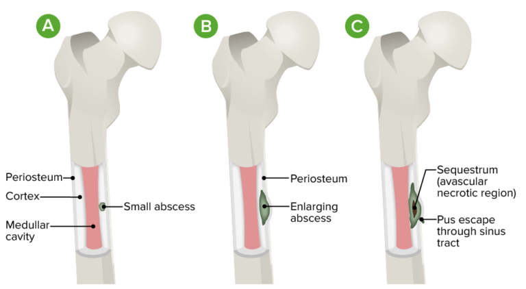 Osteomyelitis | Concise Medical Knowledge