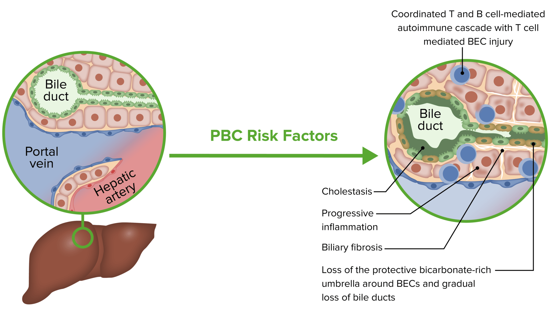 Colangitis Biliar Primaria | Concise Medical Knowledge