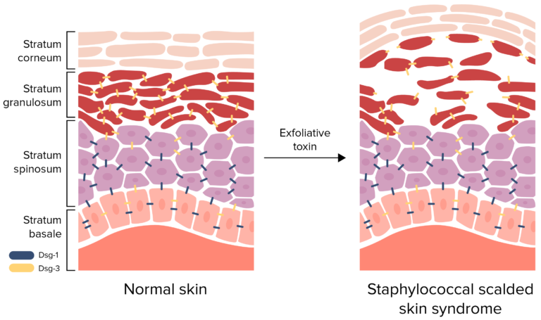 Staphylococcal Scalded Skin Syndrome (SSSS) | Concise Medical Knowledge