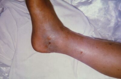 Snakebites | Concise Medical Knowledge