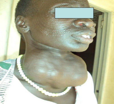 Goiter | Concise Medical Knowledge