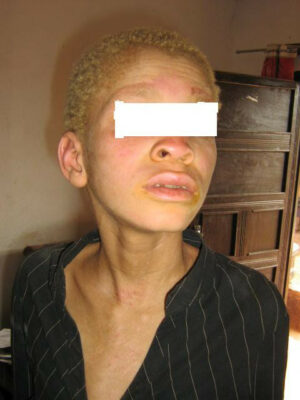 Albinism [+video] - Lecturio Medical