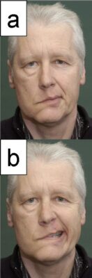 Lyme Disease | Concise Medical Knowledge