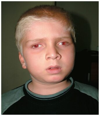 Albinism [+video] - Lecturio Medical