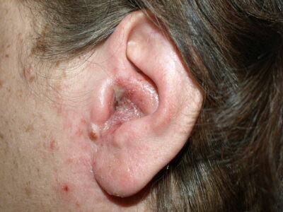 Otite Externa | Concise Medical Knowledge