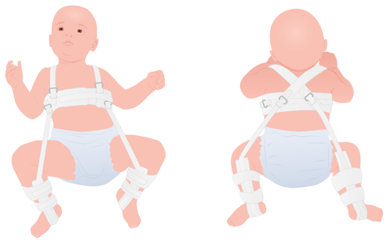 Developmental Dysplasia of the Hip | Concise Medical Knowledge
