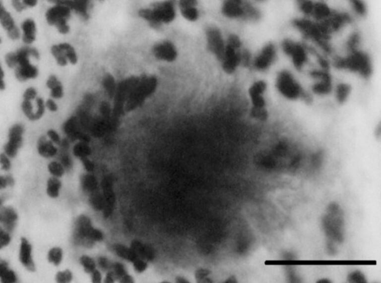 Actinomyces/Actinomycosis | Concise Medical Knowledge