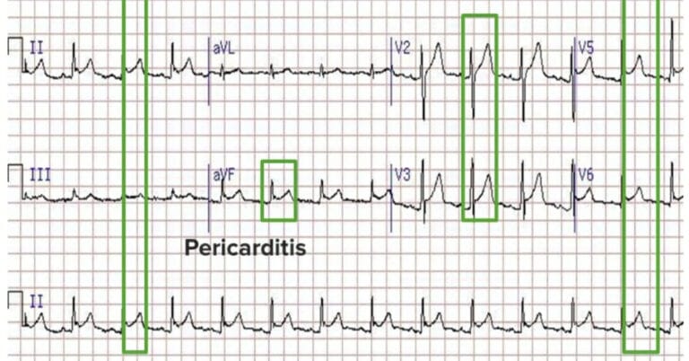 12-Lead ECG Placement: Step-by-Step Guide | Lecturio Medical