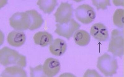Babesia/Babesiosis | Concise Medical Knowledge