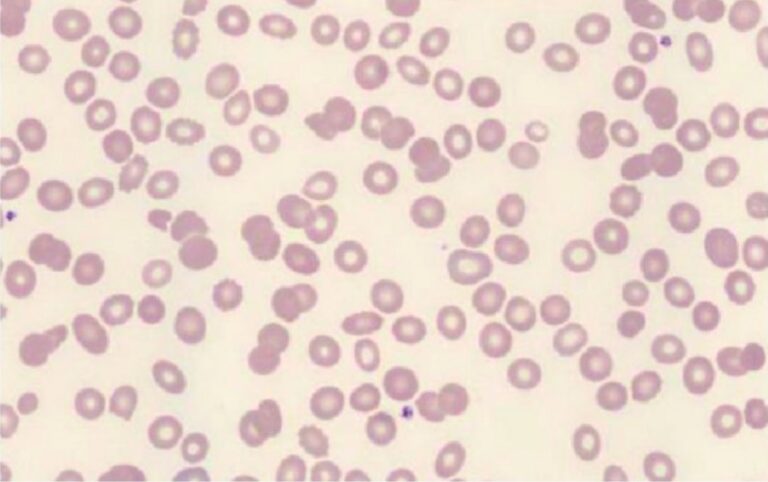 Neutropenic Fever | Concise Medical Knowledge