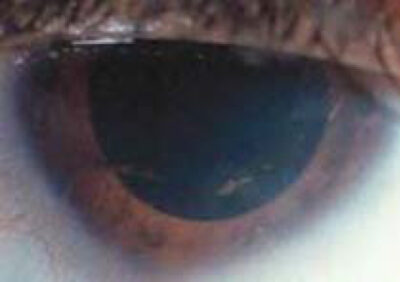 Anomalies of the Cornea | Concise Medical Knowledge