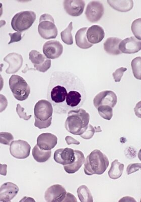 Myelodysplastic Syndromes | Concise Medical Knowledge